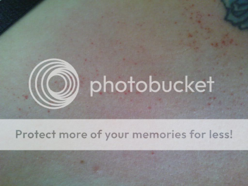 Annoying itchy red-dotty rash! — Digital Spy